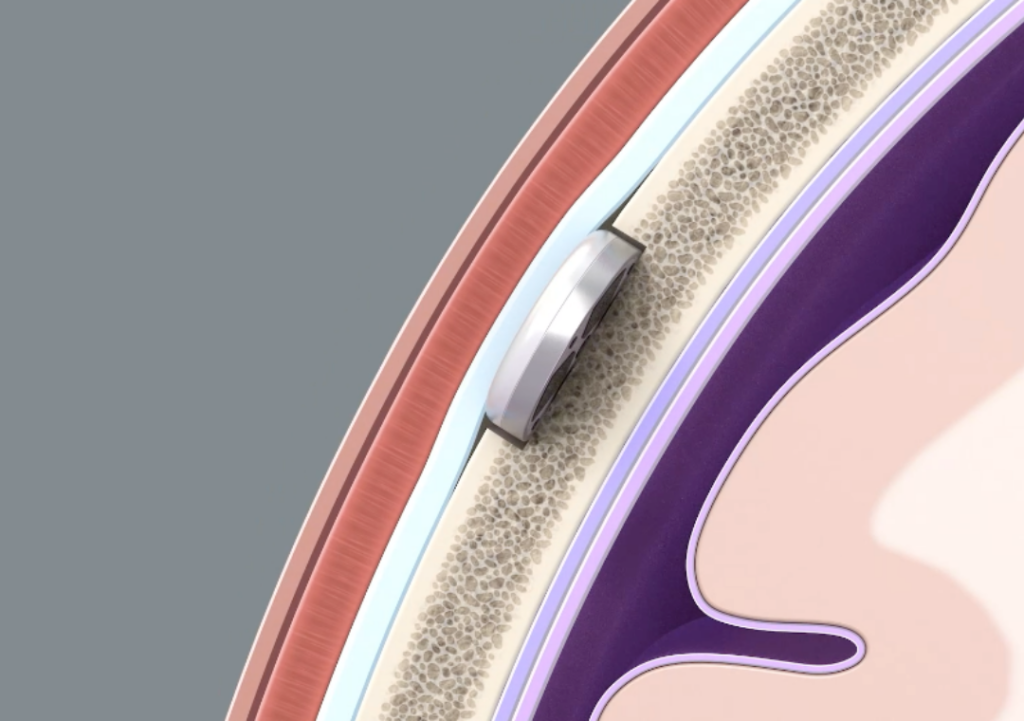 Neurotechnology - Taylor Family Department of Neurosurgery