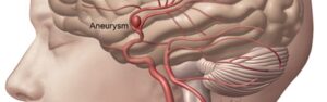 Brain Aneurysms - Neurosurgery