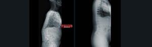 Spinal Deformity - Sagittal Imbalance - Neurosurgery
