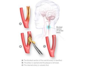 Carotid Stenosis - Neurosurgery