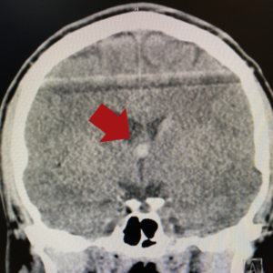Brain Cysts - Taylor Family Department of Neurosurgery